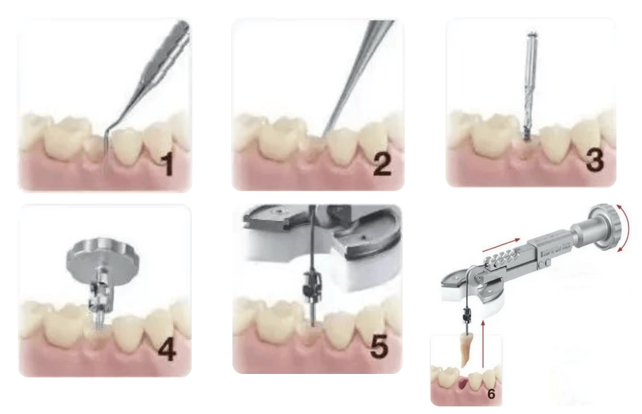 【健康一点通】无创拔牙——垂直牵引拔牙技术_Benex_口腔_临床