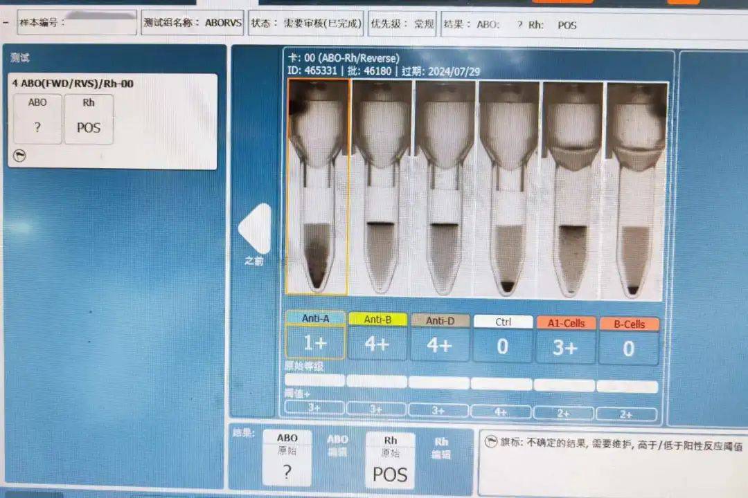 比“熊猫血”更少见！佛中医发现罕见血型AelB，这类人群如何输血？_叶俏霞_血液_检测