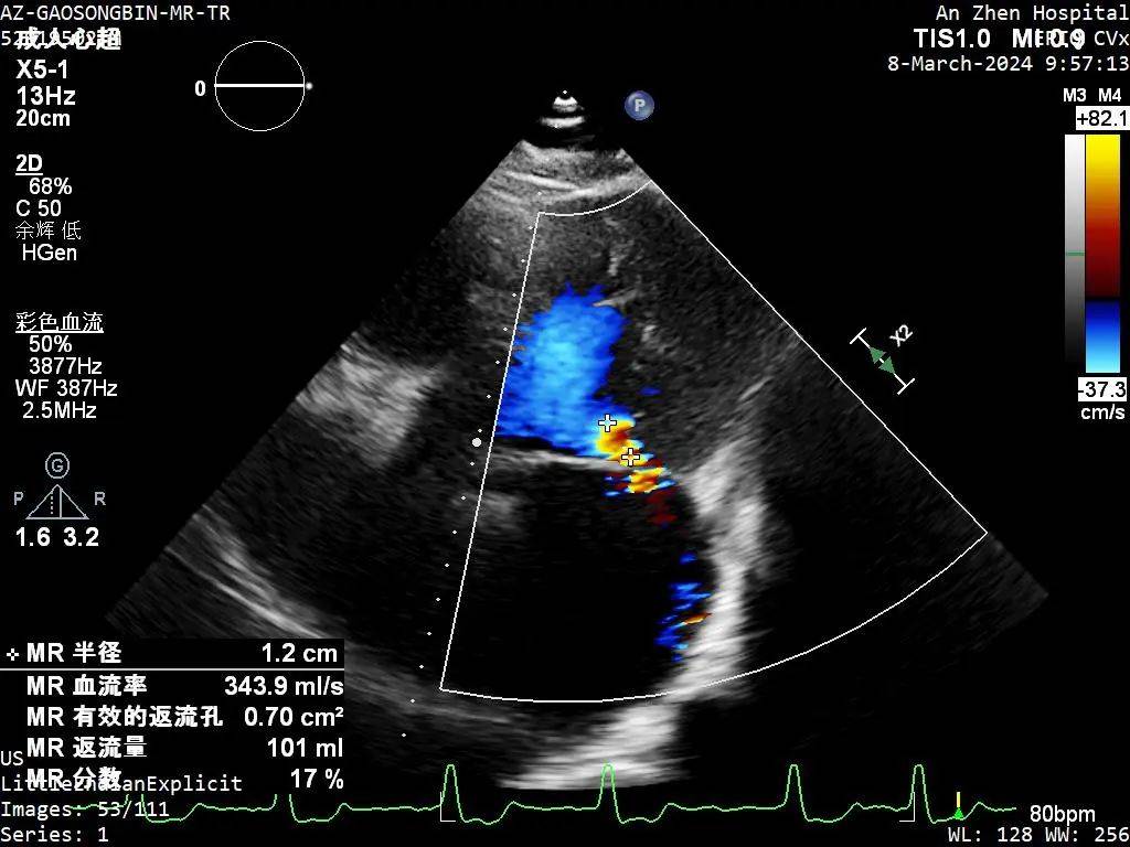 “贞”心一“课”｜巨大左房AFMR行TEER一例_二尖瓣_瓣膜_患者