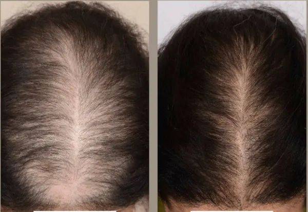 PRP+丽珠兰：“头”等大事，双管齐下！_毛囊_芝加哥_皮肤