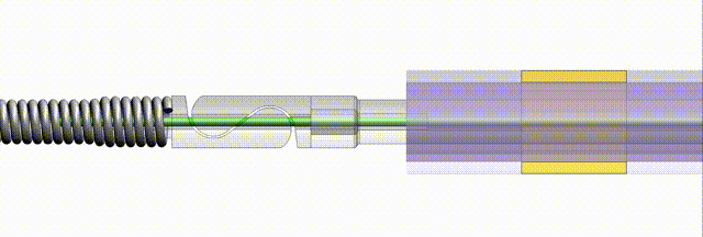 灵动至简｜EMBOLD Fibered外周机械解脱带纤维毛弹簧圈获国家药品监督管理局批准上市_栓塞_术者_治疗