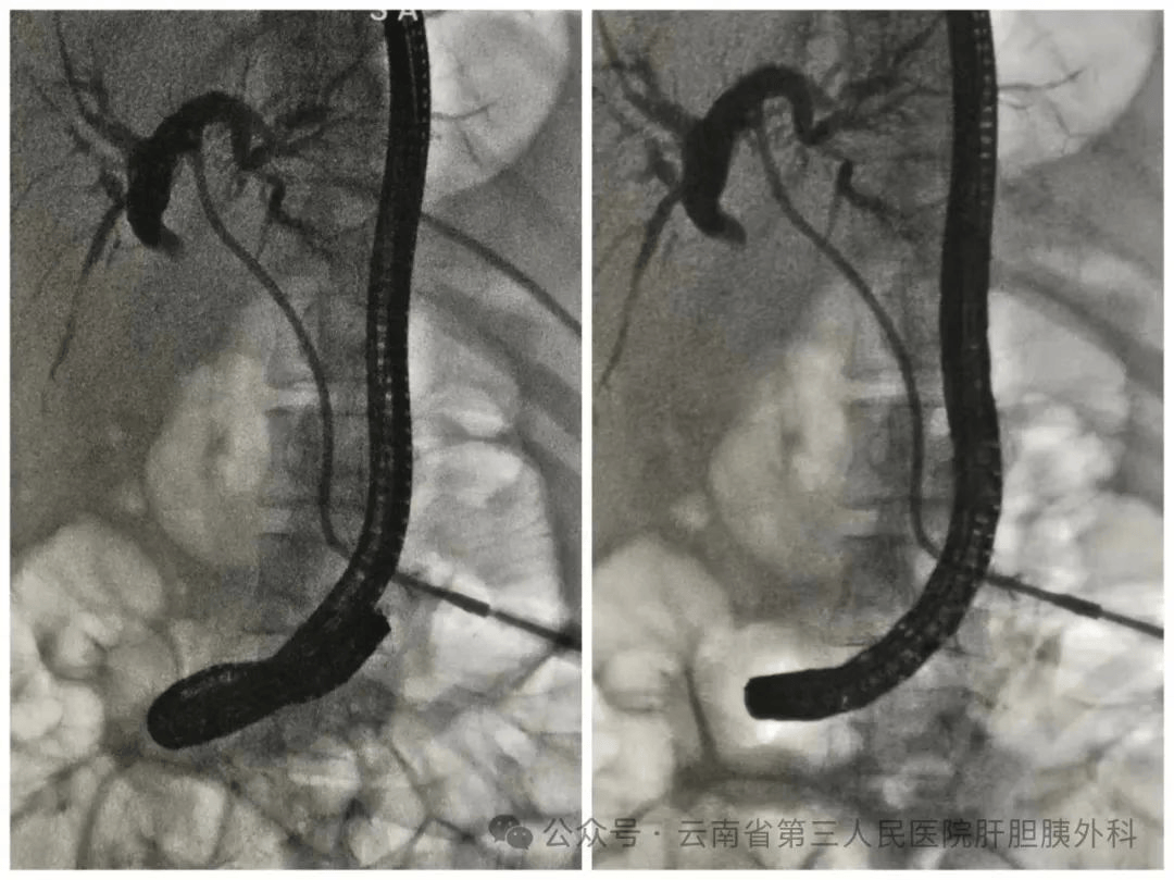 【省三院·临床现场】肝胆胰外科成功开展医院首例经皮肝穿刺胆道引流术(PTCD)+胆道支架置入术_患者_胆管_手术